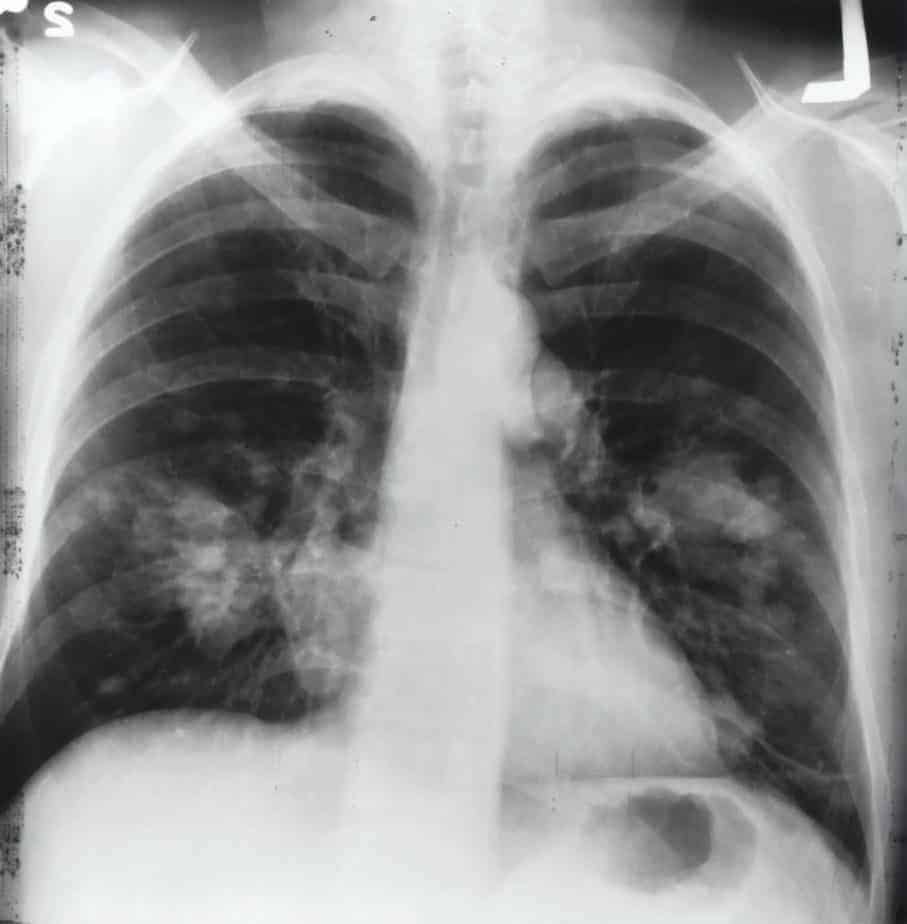 La genética del carcinoma de pulmón de células escamosas (McKay, 2017)