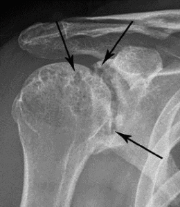 Is rheumatoid arthritis genetic? | Decode your DNA and learn your risks!