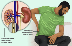 Are Kidney Stones Genetic? | Decode your DNA and learn your risks!