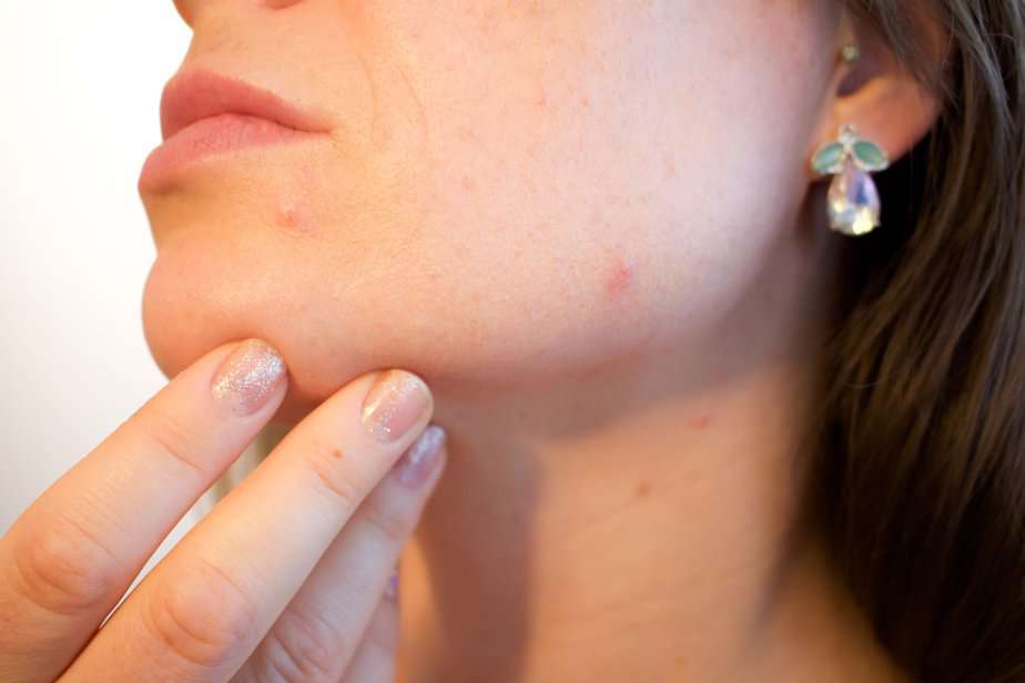 Is Acne Genetic? | Decode your DNA and learn about your risks!