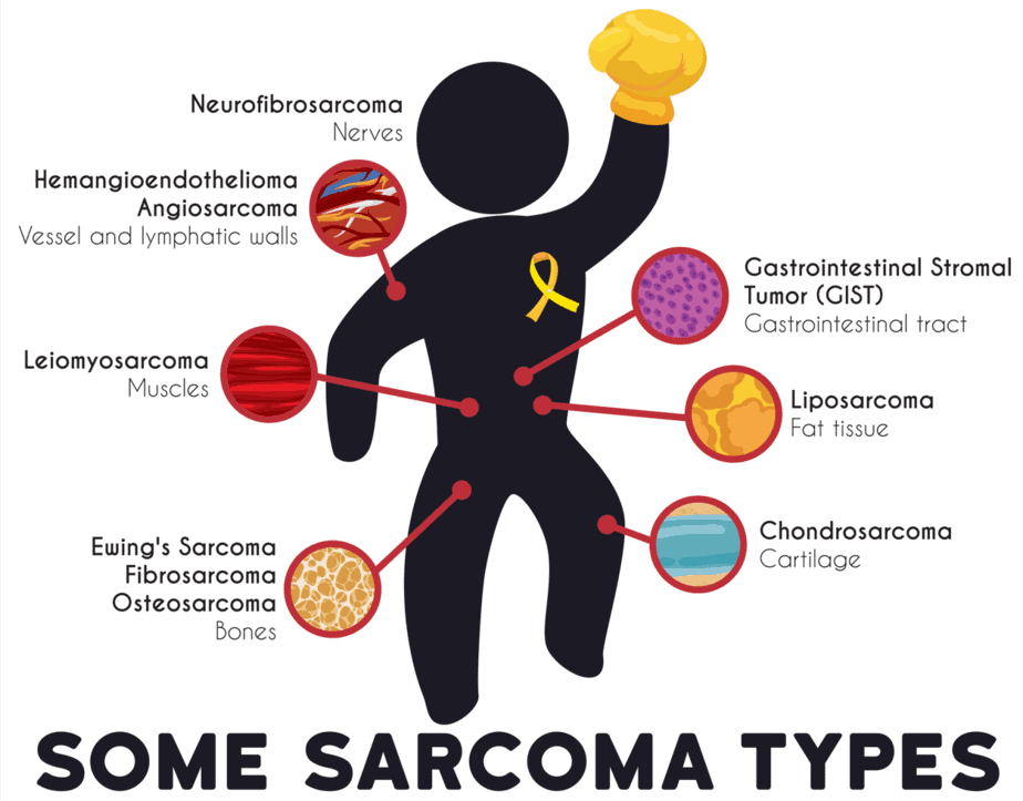 A Genetic Map Uncovering the Heritability of Sarcoma