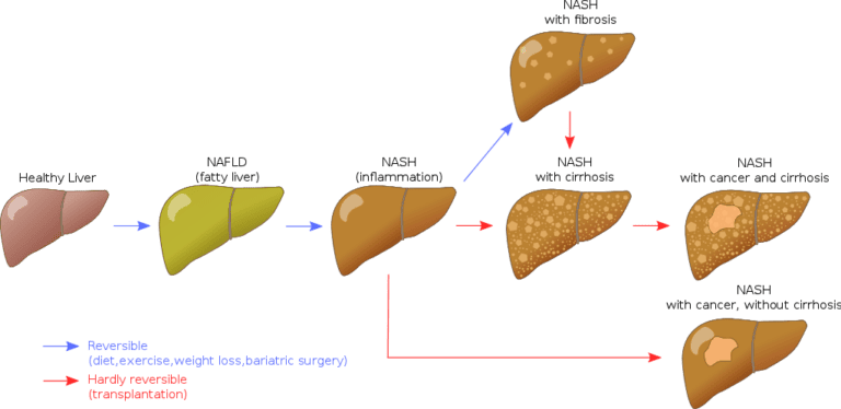 The Protective Role of CIDEB Variants Against Liver Disease