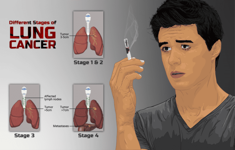 Is Lung Cancer Genetic? | Decode your DNA and learn your risks!