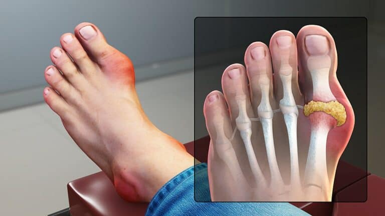Is gout genetic? | Decode your DNA and learn about your risks!