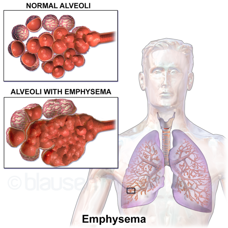 Is emphysema genetic? | Decode your DNA and learn your risks!